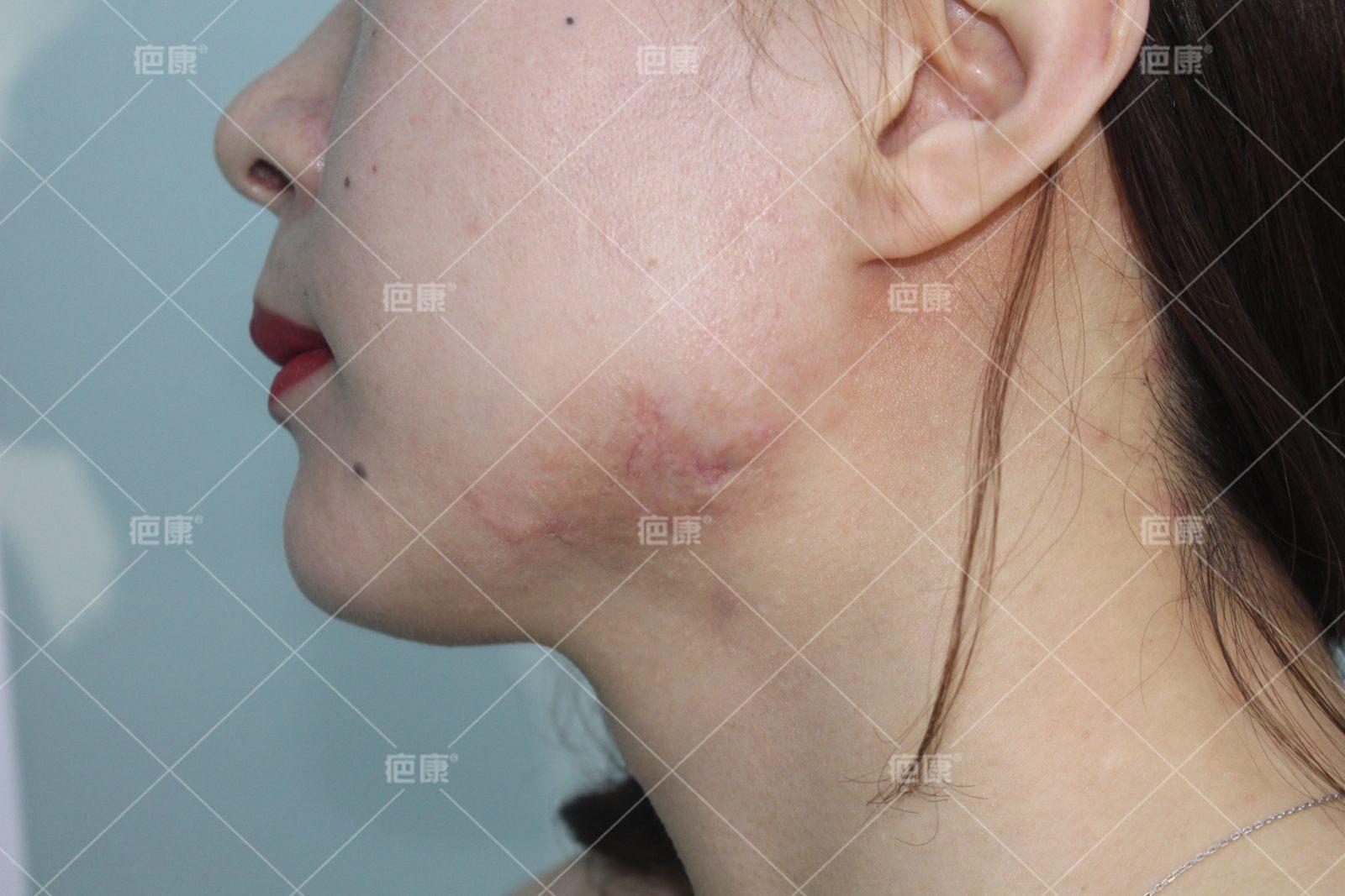 (Scar Kang) There are keloids on my face, I dare not look at people - iNEWS