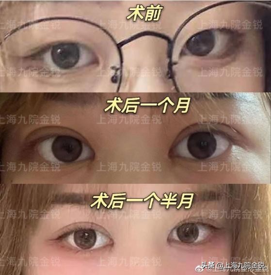 Double eyelid VS single eyelid, why do more people like double eyelid ...