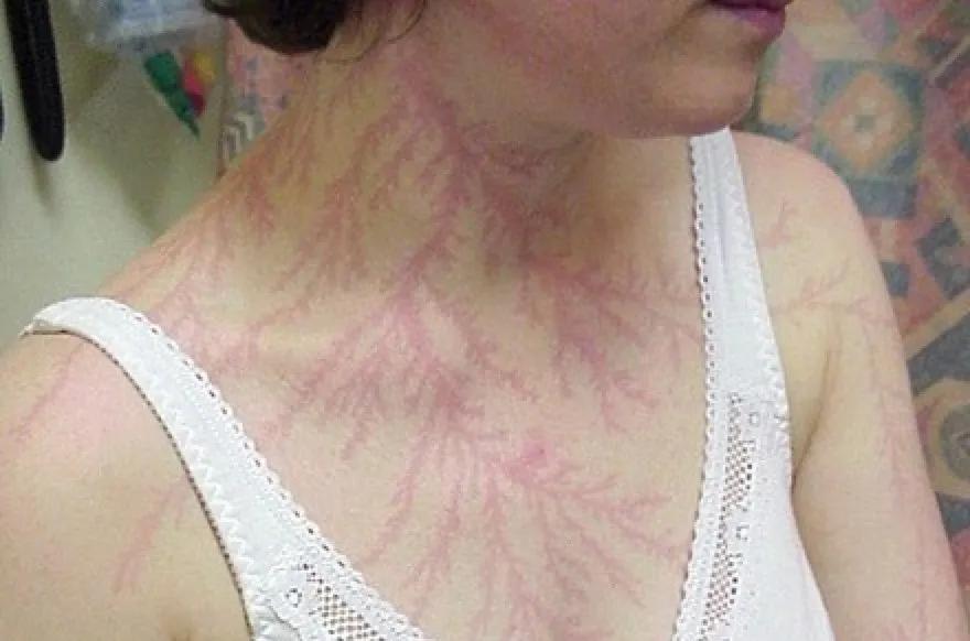 Why are men more likely to be struck by lightning? - iNEWS