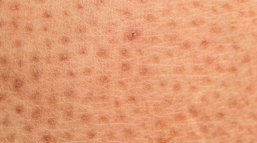 What should I do if I have a lot of goose bumps on my arms and legs?4 ...
