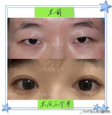 Double eyelid VS single eyelid, why do more people like double eyelid ...