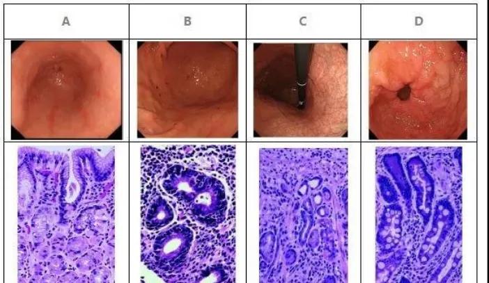 What is chronic superficial gastritis?From the cause to the treatment ...