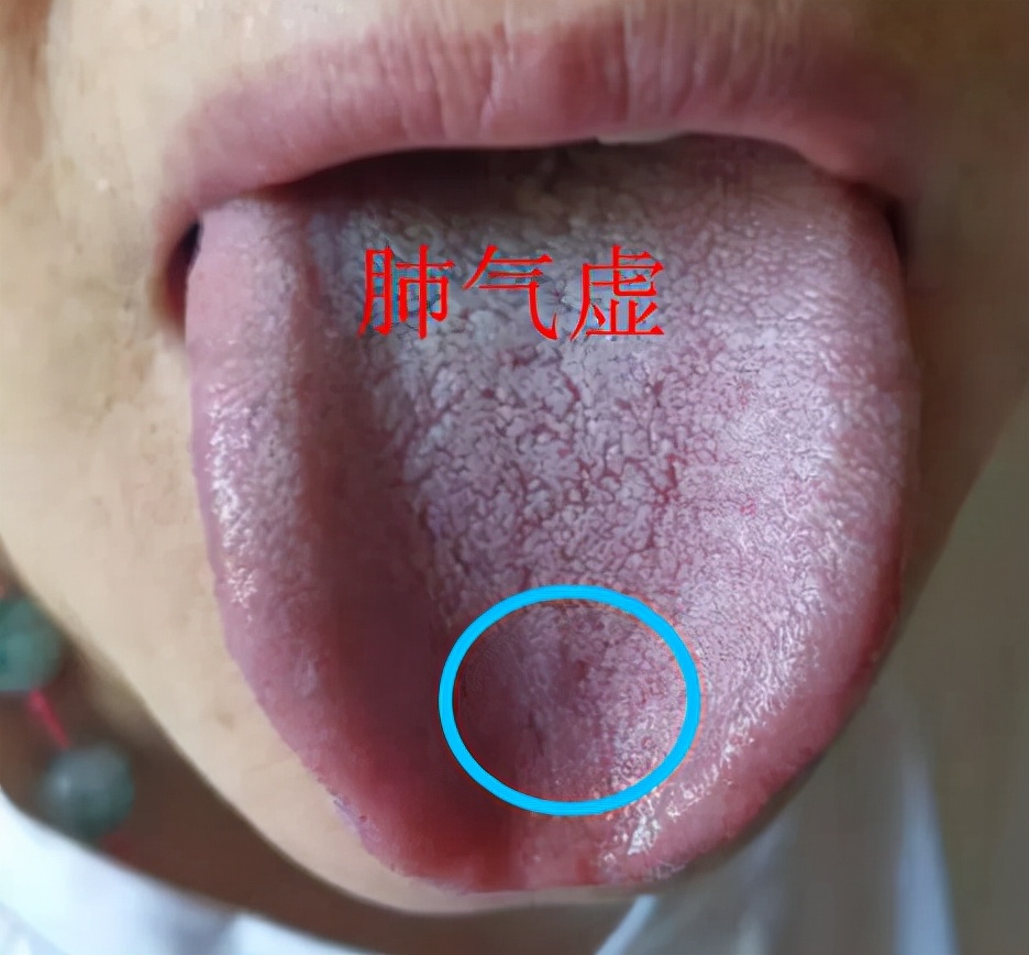 Deficiency of Qi?Is the spleen qi deficiency, lung qi deficiency, or ...