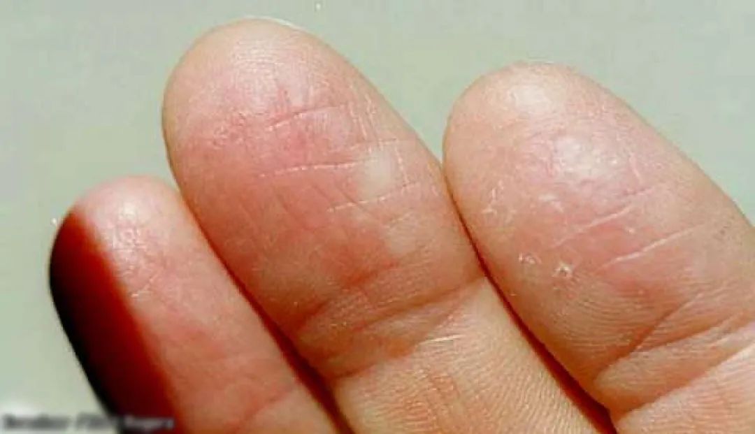 Will those who are born without fingerprints become true extrajudicial ...