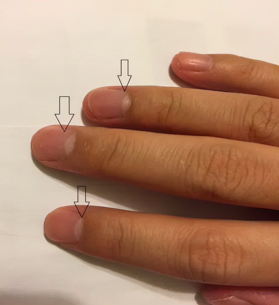 Is your kidney good? You can tell by looking at your nails?Doctor: Be ...