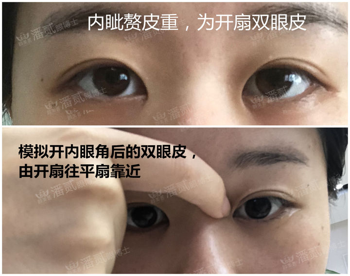 After opening the outer corner of the eye, there is heavy scarring ...