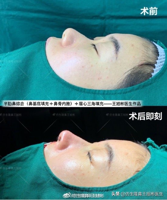 What is a box nose?Can a rhinoplasty doctor make a natural and advanced ...