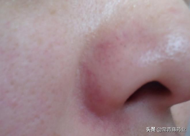 T-zone is always oily, and the wings of the nose are still red. Have ...