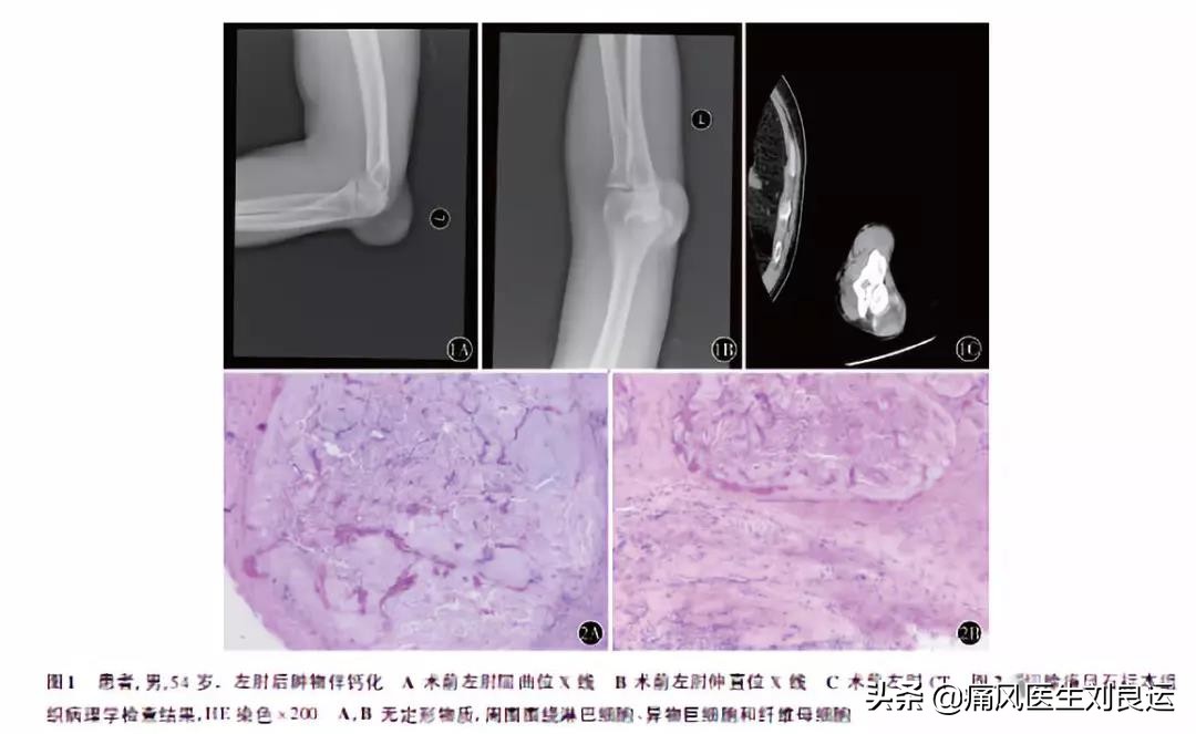 There is no need for surgery after tophi, because if it is cut, it will ...