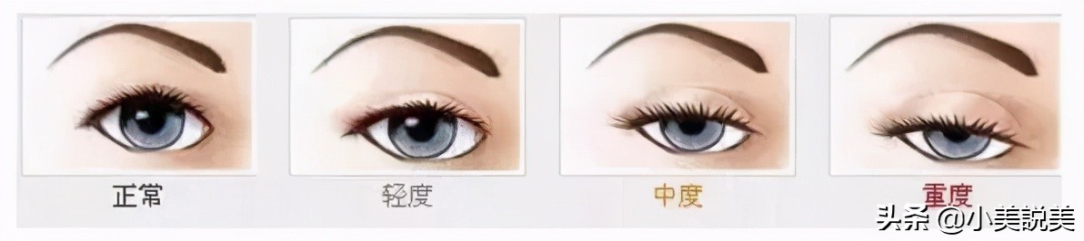 What causes the weakness of the upper eyelid levator muscle - iNEWS