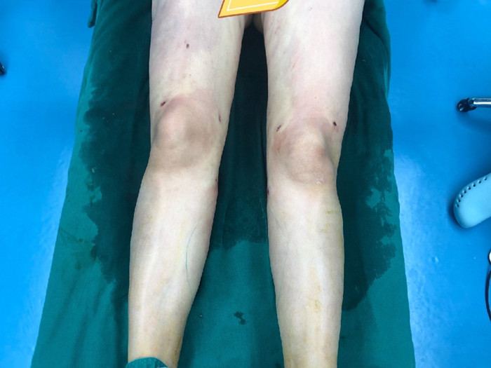 Do you know about body liposuction, including which parts and how many ...