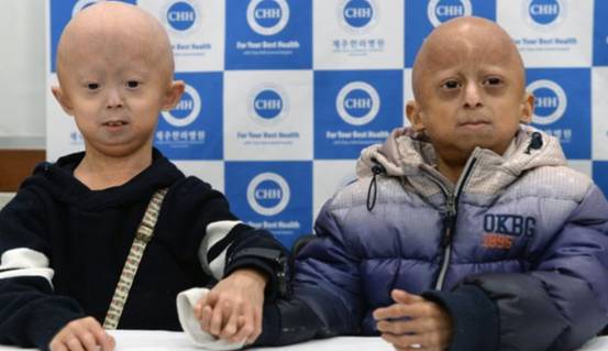 How terrible is Progeria?A 16-year-old woman from the Philippines grows ...