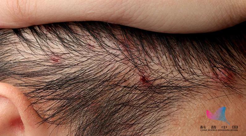 What are the "small bumps" on the scalp?How to prevent it?The answer is ...