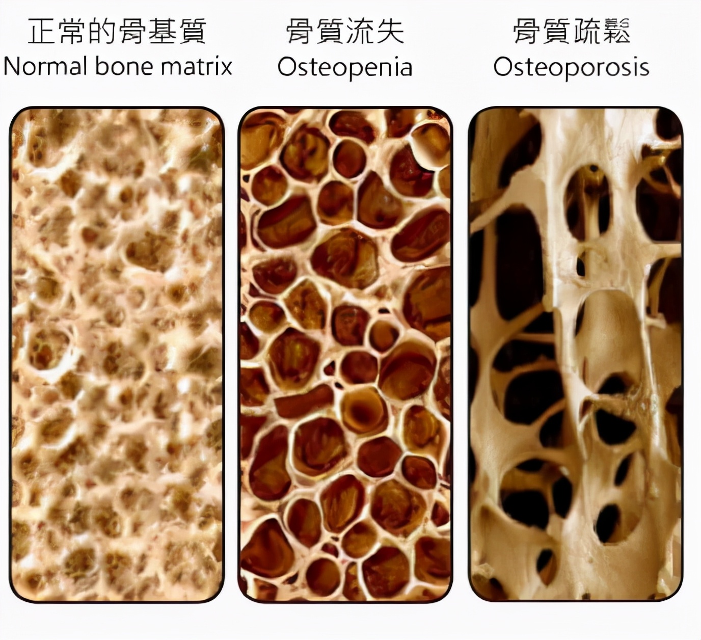 Astronaut bone loss "one month in the sky, one year on the ground", the ...