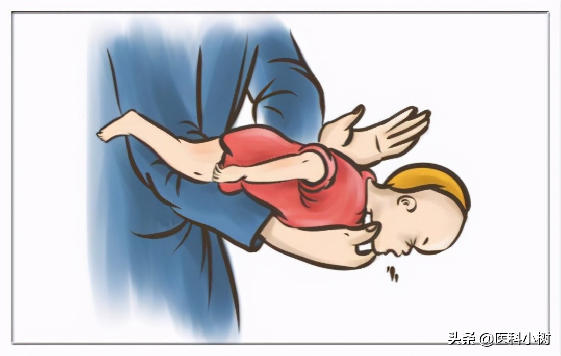 Emergency treatment of suffocation of foreign body in children - iNEWS