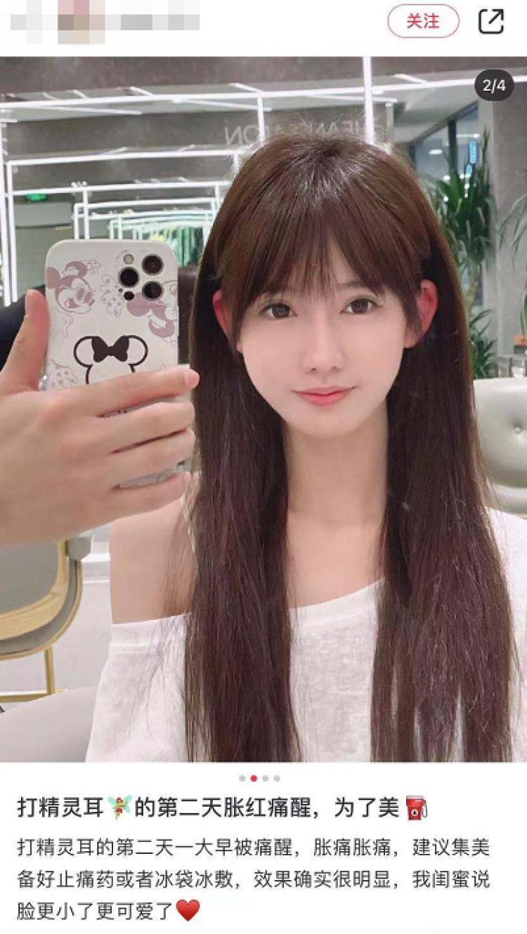 "Elf Ears" became popular in plastic surgery circle!Netizen: My windy ...