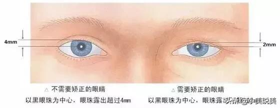 What causes the weakness of the upper eyelid levator muscle - iNEWS