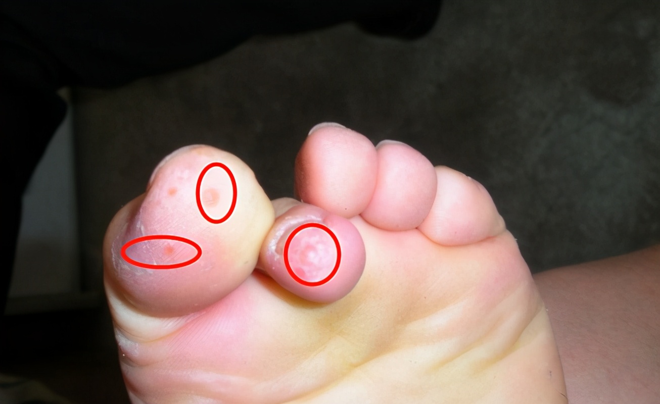 Rotten toe blisters, thick heel, doctor diagnosed: mixed athlete's foot ...