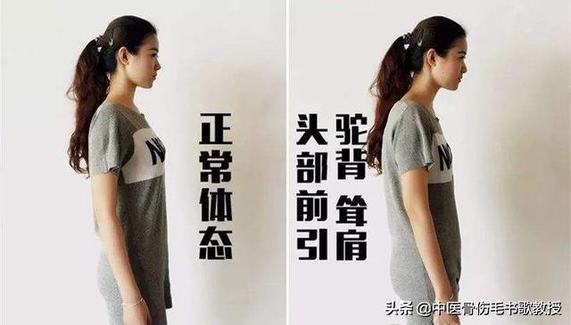 What to do with hunchback?4 actions to teach you to correct hunchback ...