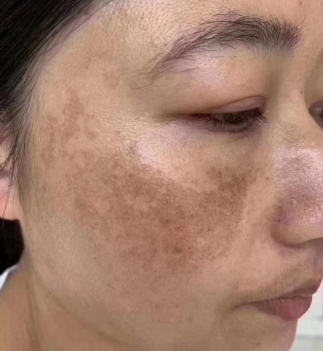 A case of treatment of maladjusted chloasma within 42 years old, 1 ...