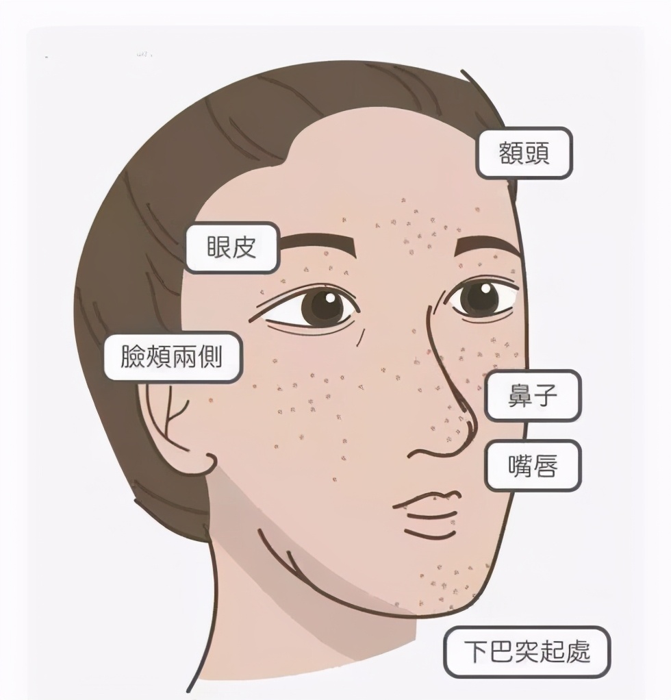 Melasma is actually a sign of chronic liver disease?The cause of ...