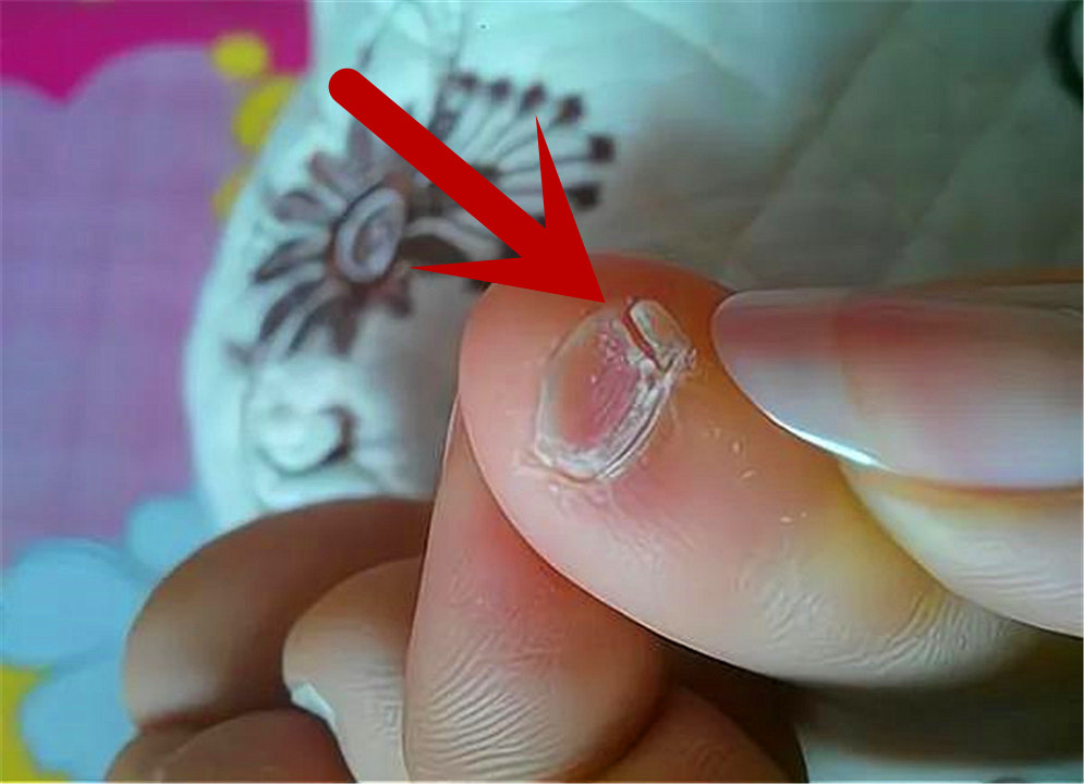 What is the origin of people who split their little toenails in two?Are ...