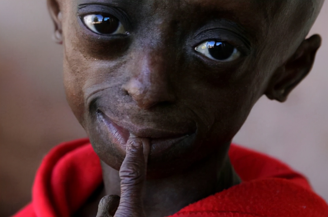 How terrible is Progeria?A 16-year-old woman from the Philippines grows ...