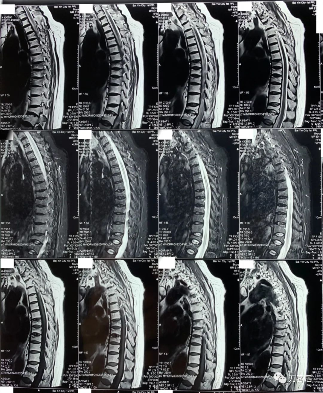 My outpatient medical record: multiple vertebral compression fractures ...