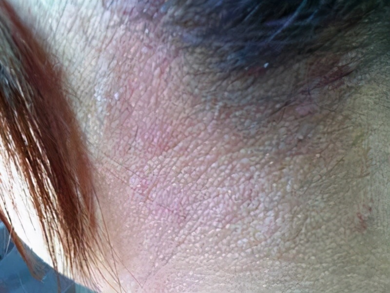 Neurodermatitis, severe itching, how to relieve it? - iNEWS