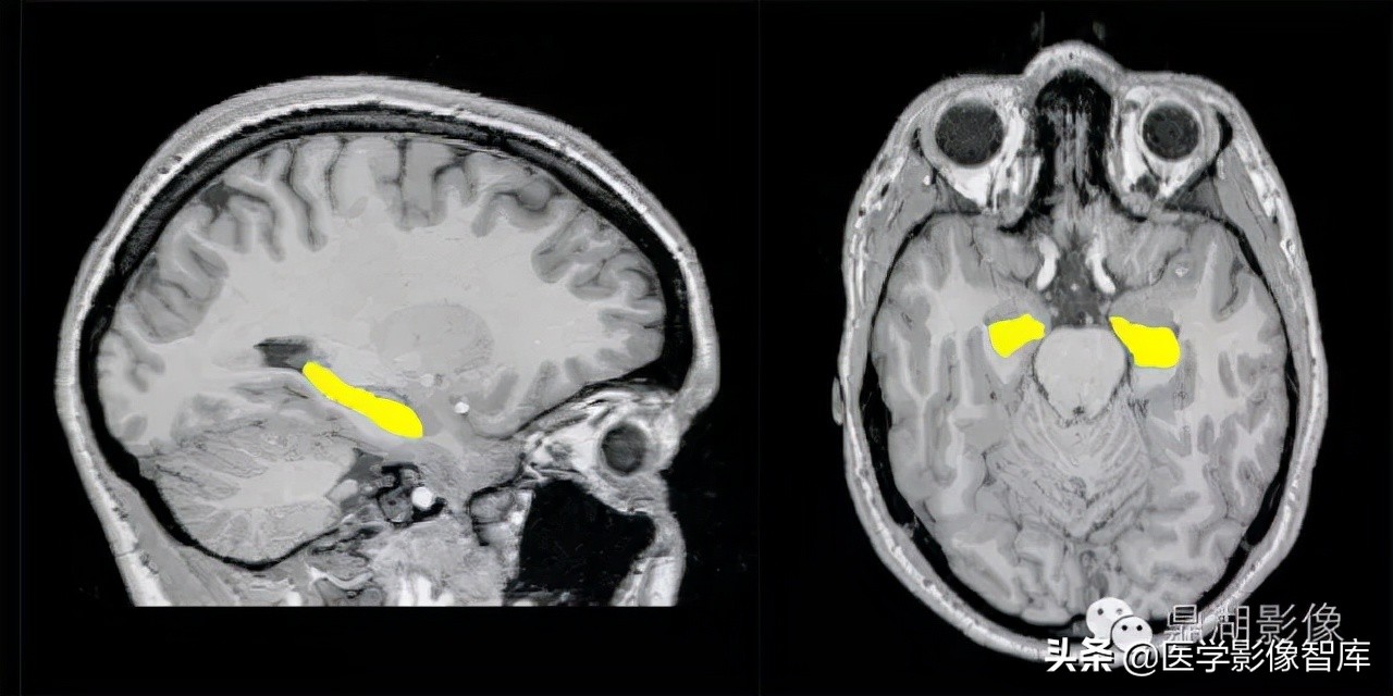 Hippocampal anatomy and imaging evaluation - iNEWS