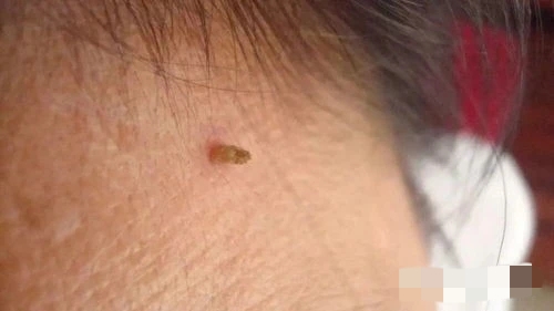 Are filamentous warts and skin tags-like? What is the difference ...