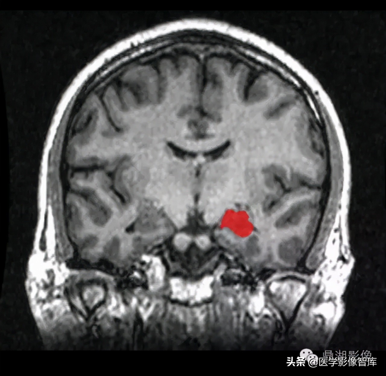 Hippocampal anatomy and imaging evaluation - iNEWS