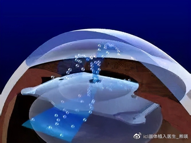 Doctor Xiong, dare you to talk about the complications of ICL surgery ...