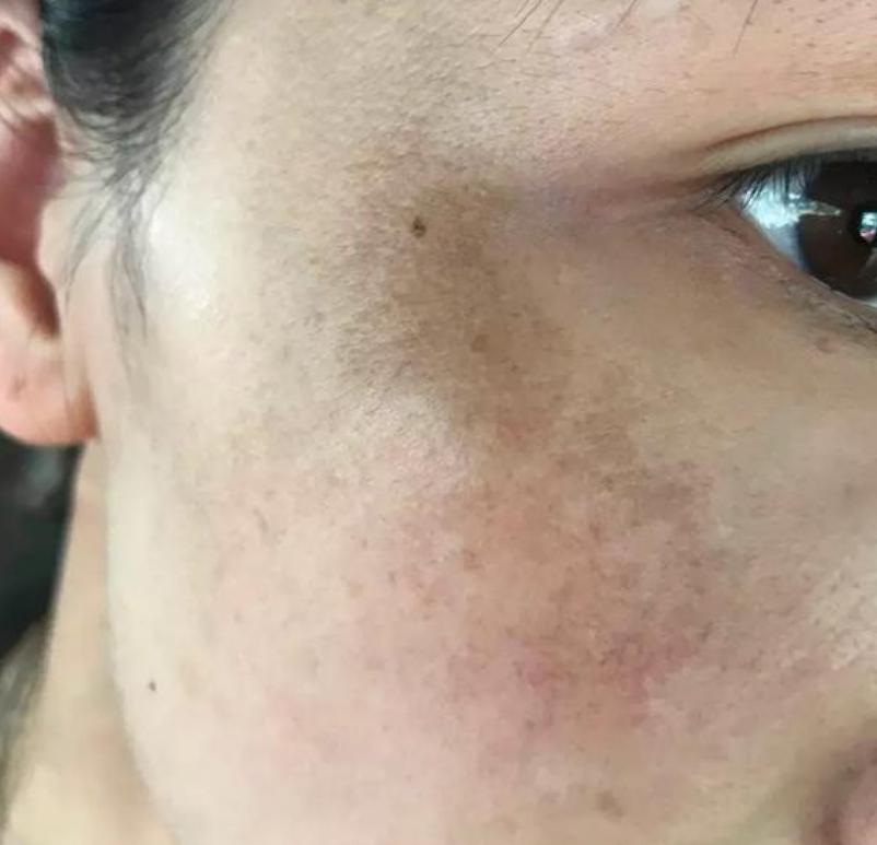 A case of treatment of maladjusted chloasma within 42 years old, 1 ...