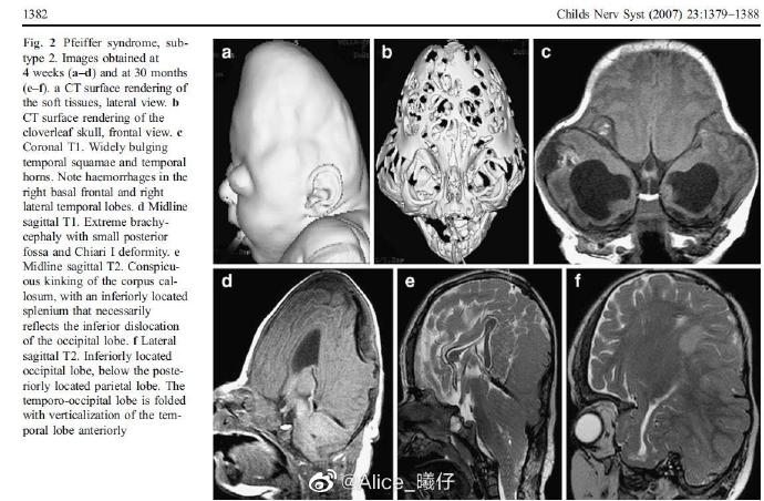 A strange baby in Rwanda, Africa, with a triangular head resembling an ...
