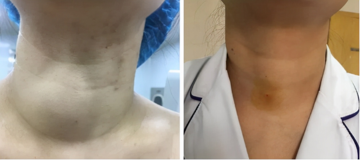 Is it better to choose minimally invasive surgery for thyroid surgery ...