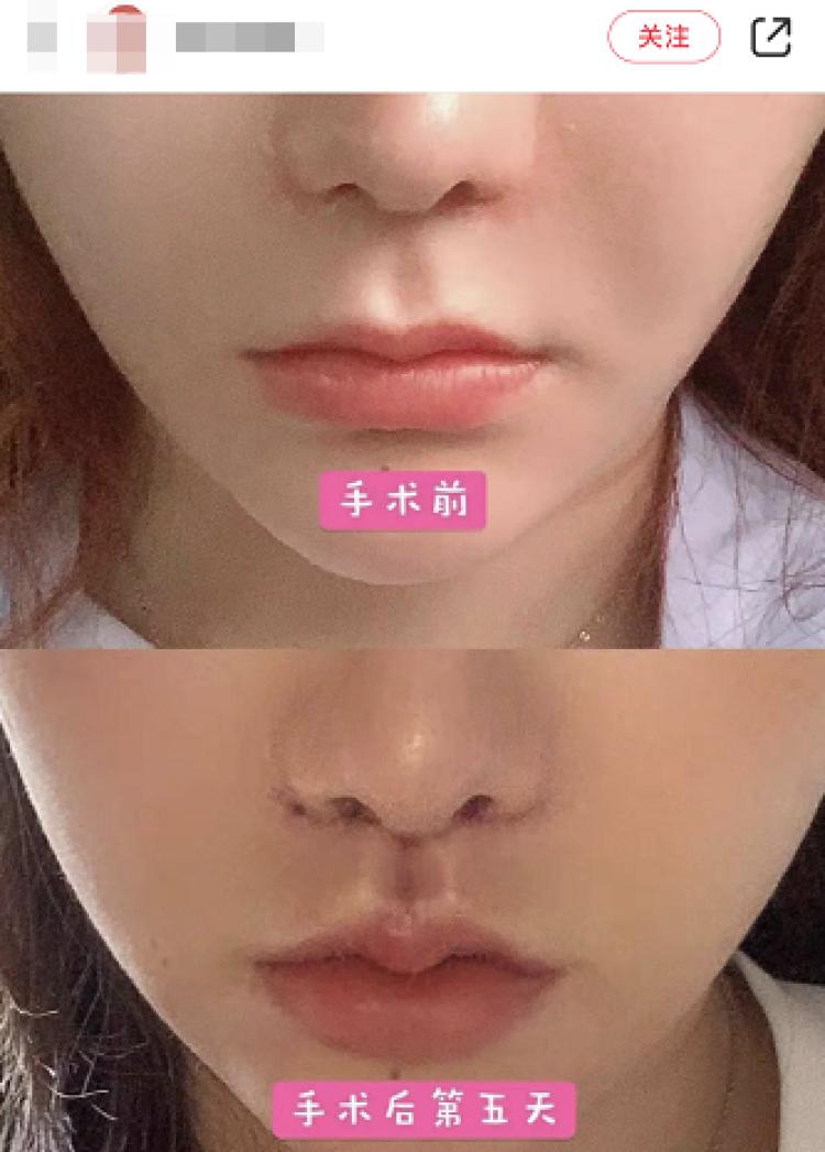 "Elf Ears" became popular in plastic surgery circle!Netizen: My windy ...