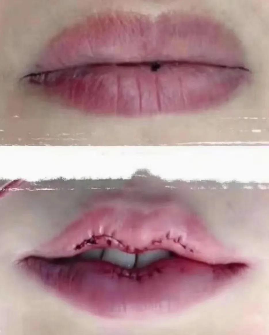 Is it risky to do M lip?I hope that the lips are plump. Is there any ...