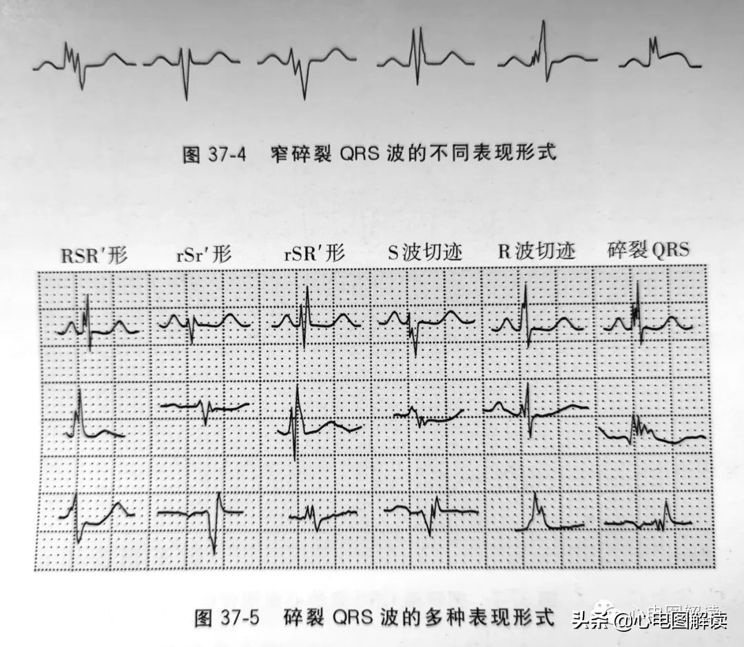 Narrow fragmentation QRS wave?Incomplete right bundle branch block? - iNEWS