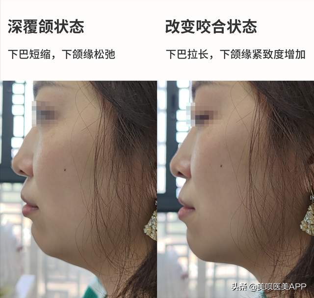 Look at the protruding girl!How can I improve the protruding mouth ...