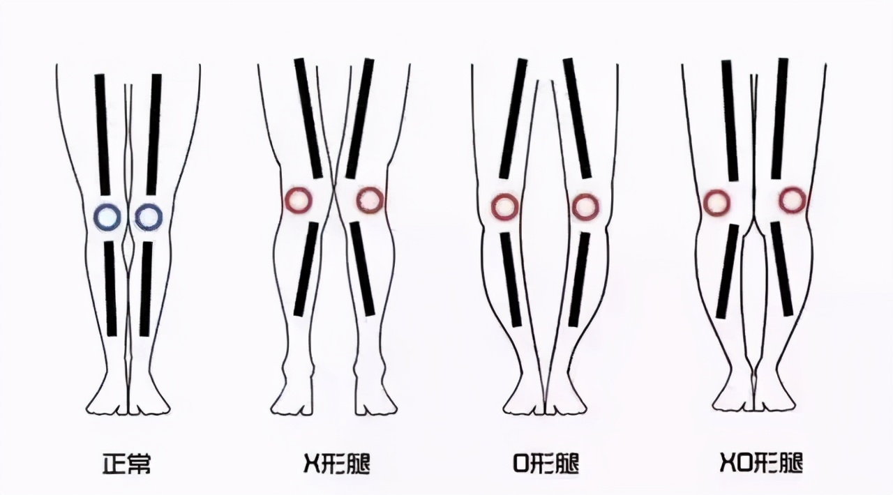 3 ugly leg types, which are you?Correcting the problem leg shape is not ...