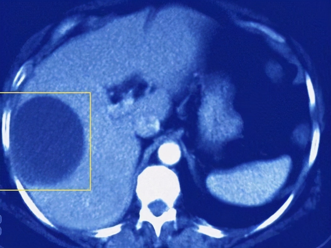 Nodules, polyps, cysts, hyperplasia, which is a precursor to cancer ...