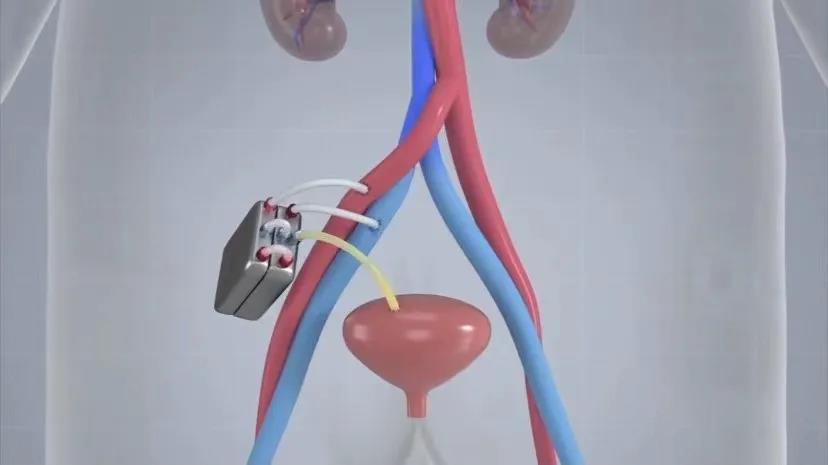 What is the research progress of implantable artificial kidney? - iNEWS