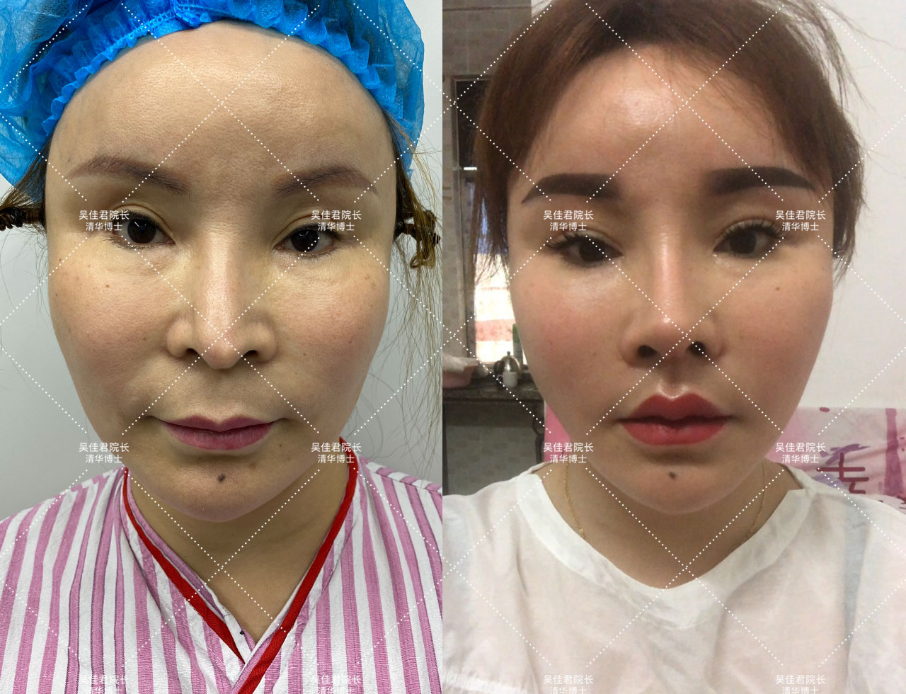 At the age of 50, she had a small facelift, and she changed from an ...