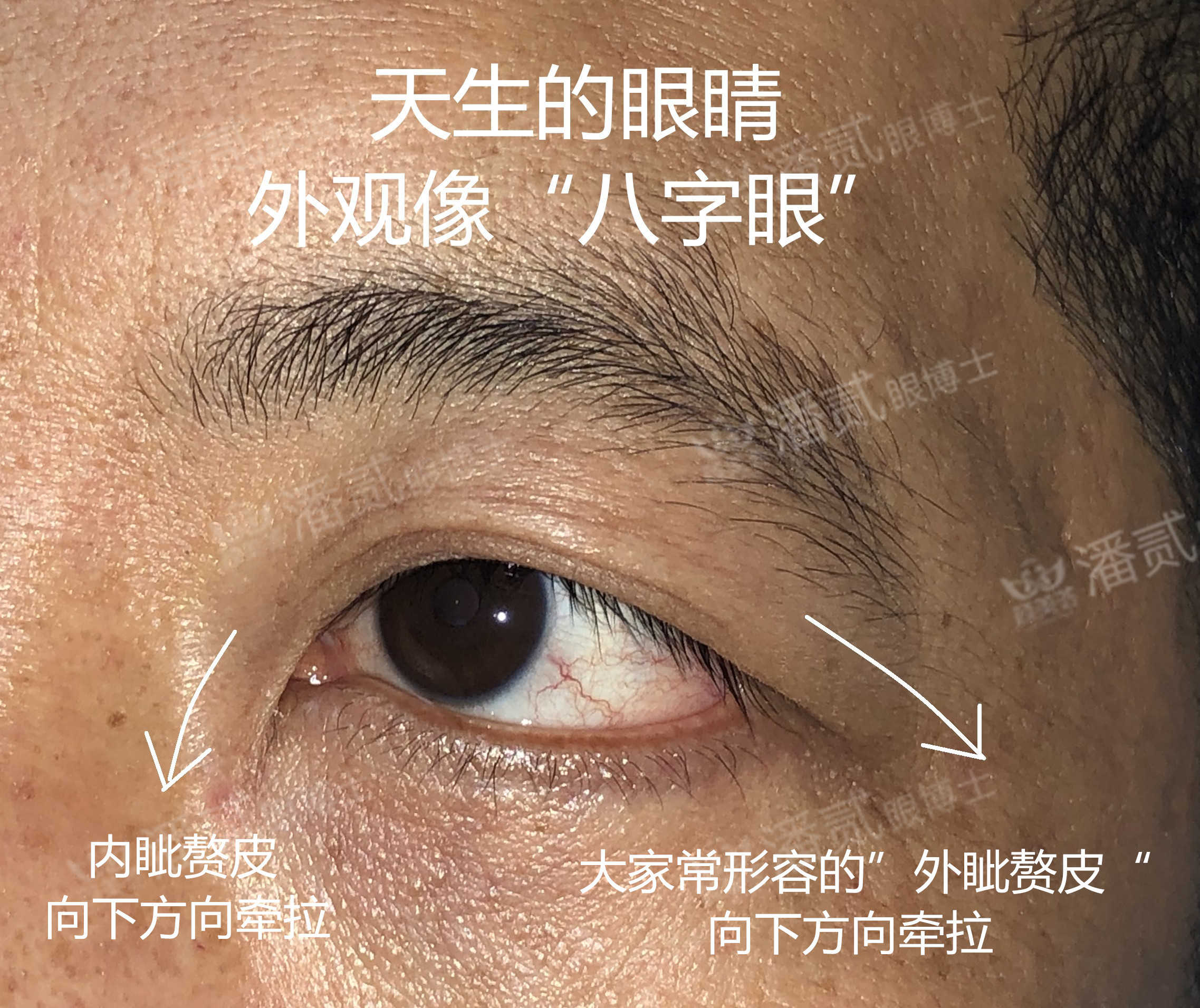 Can the drooping tail of the eye be changed by double eyelid surgery ...