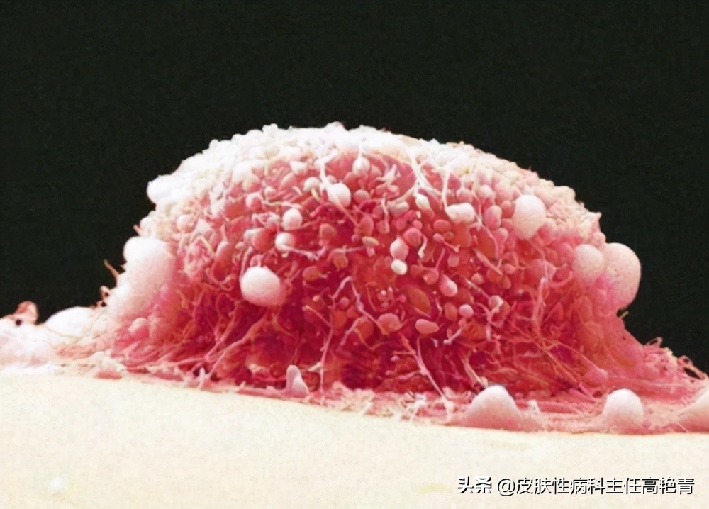 What should I do if I have condyloma acuminatum?What should I pay ...