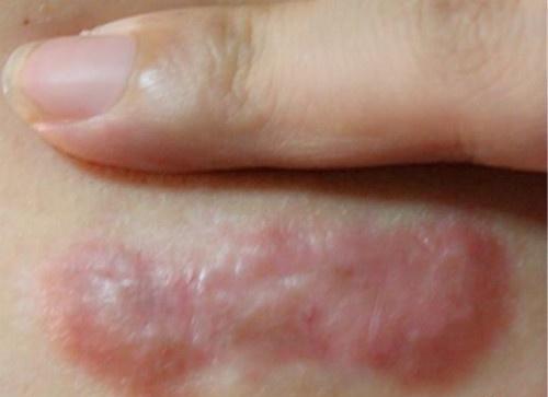 Why does the hyperplastic scar recur after treatment? - iNEWS