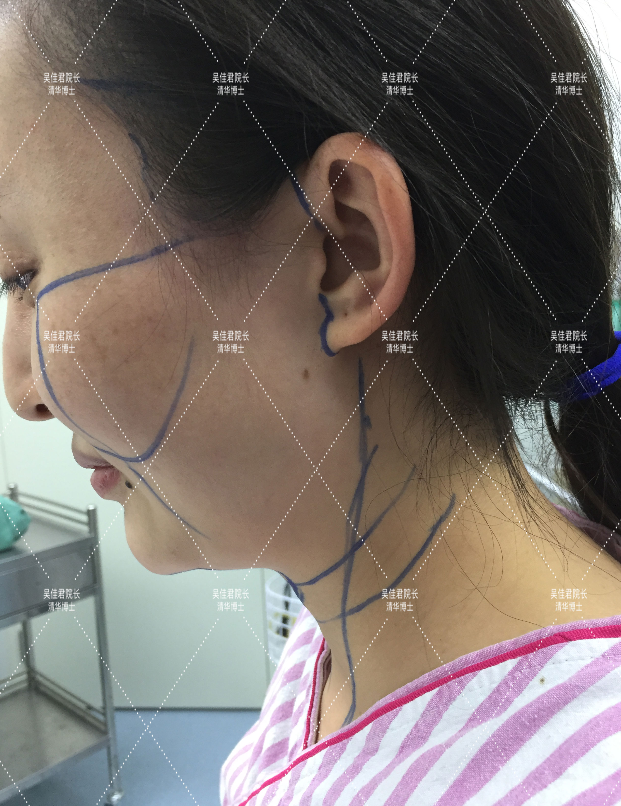 Face collapsed when he was only in his 30s?do not be afraid!Little Lapi ...