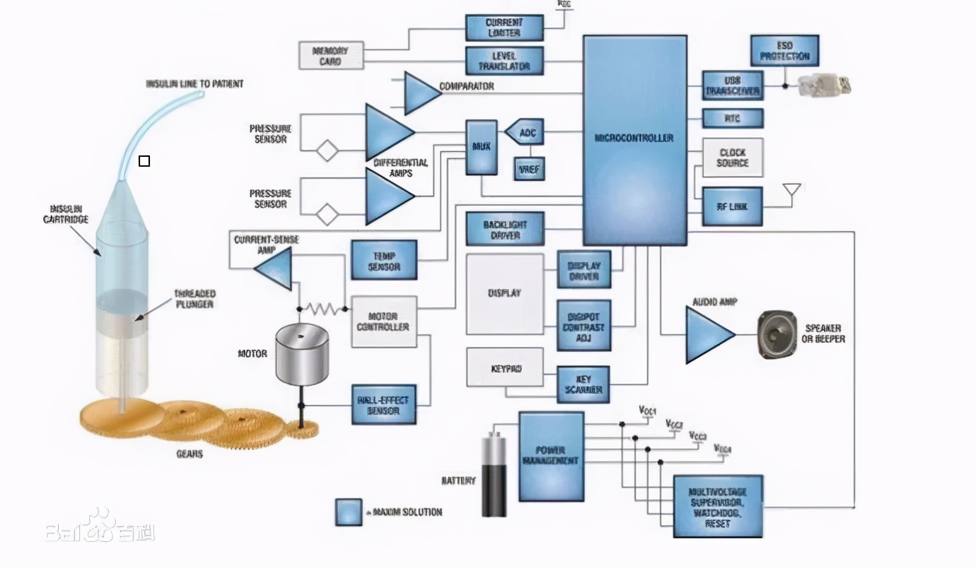 Is the pancreatic islet pump of a diabetic patient being complained ...