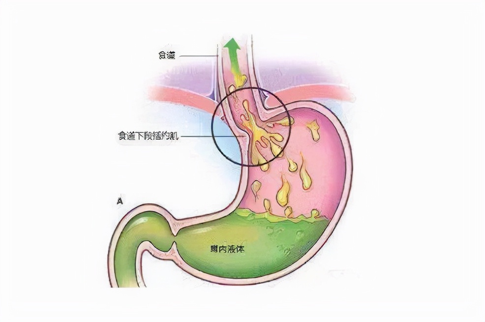 What are the symptoms of bile reflux gastritis - iNEWS